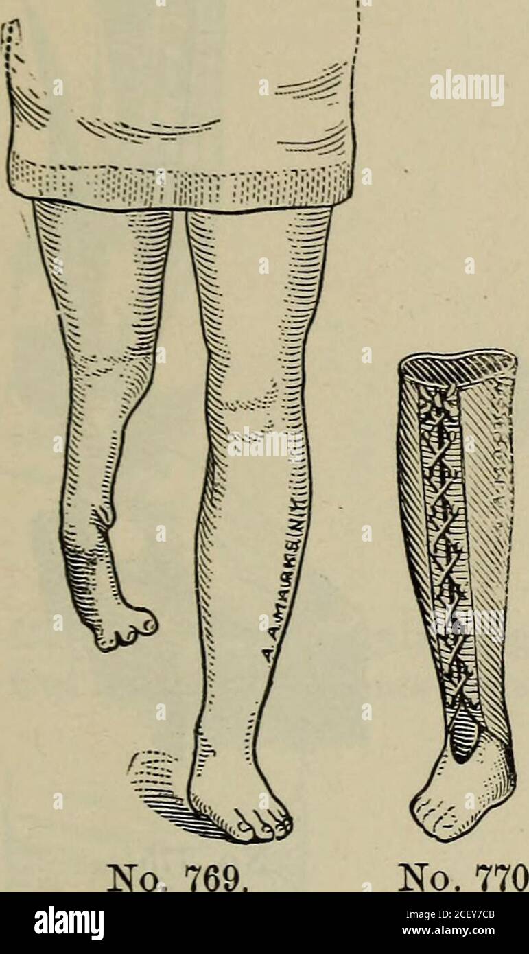 Malformed joints hi-res stock photography and images - Alamy