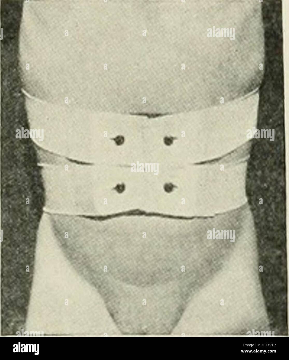 . Abdominal hernia : its diagnosis and treatment. day for the purpose ...