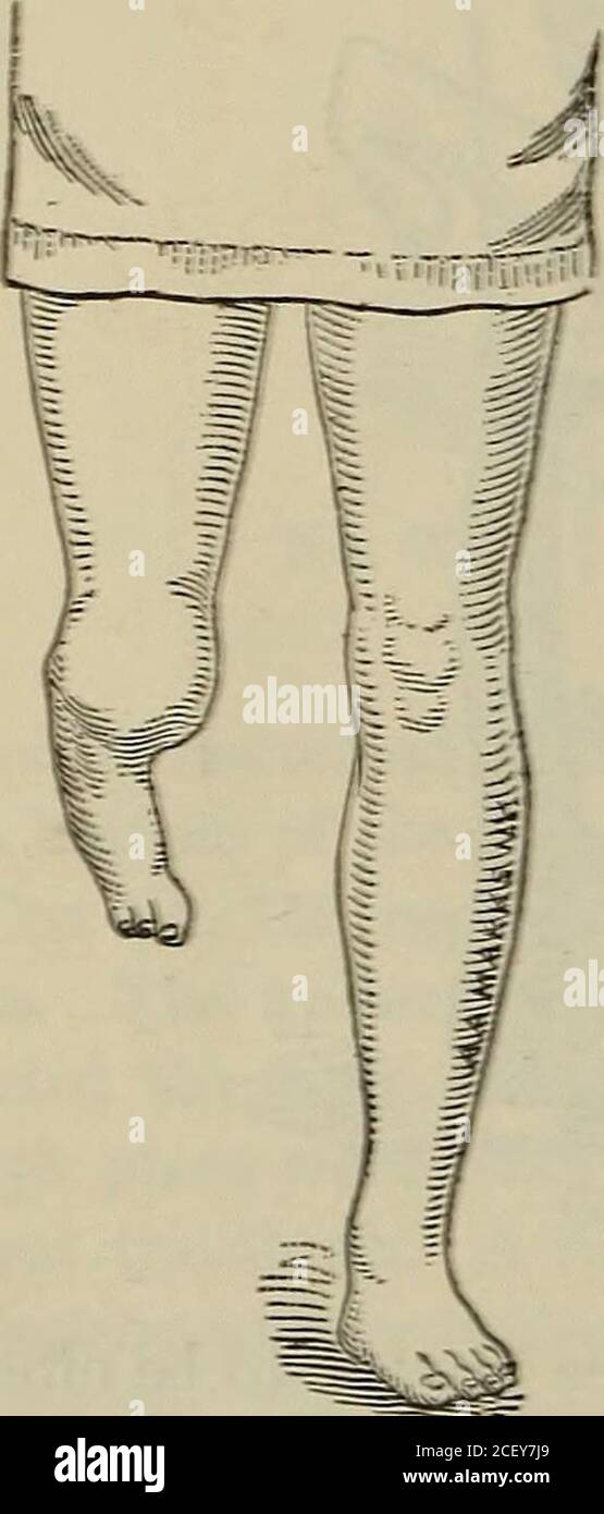 . A treatise on artificial limbs with rubber hands and feet ... >to No ...