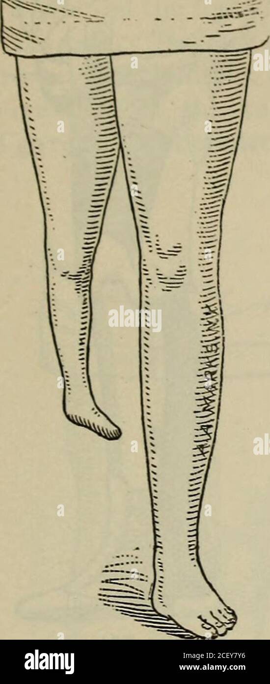 . A treatise on artificial limbs with rubber hands and feet ...