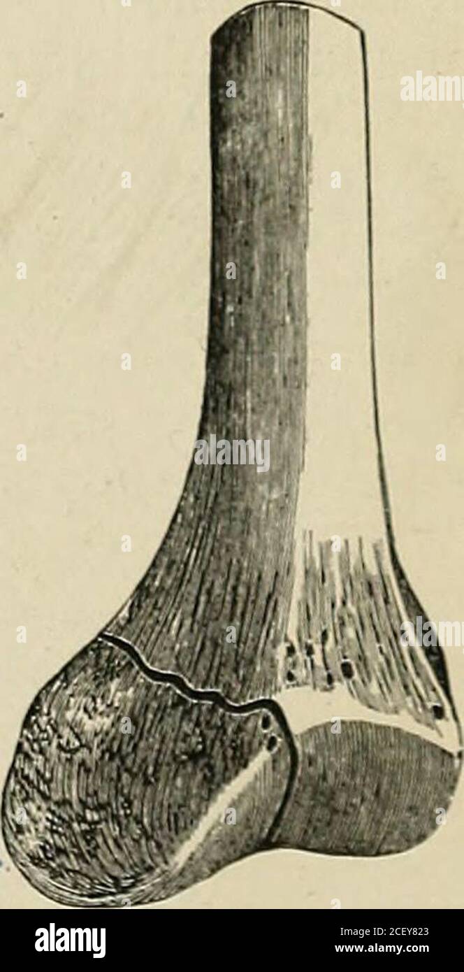 Femur condyle fracture hi-res stock photography and images - Alamy