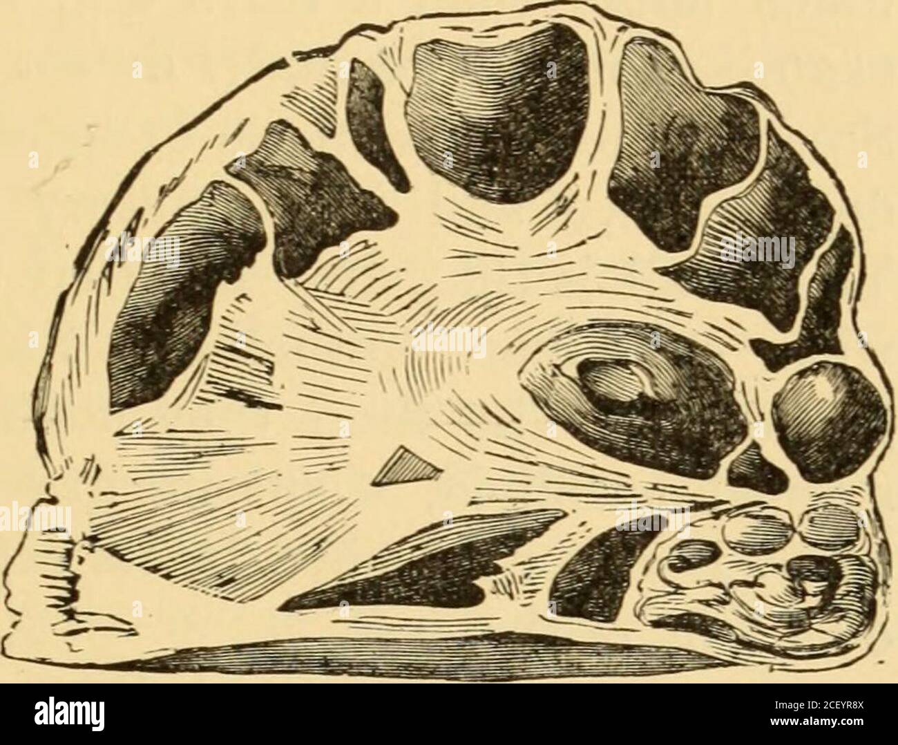 Cyst on ovary hi-res stock photography and images - Alamy