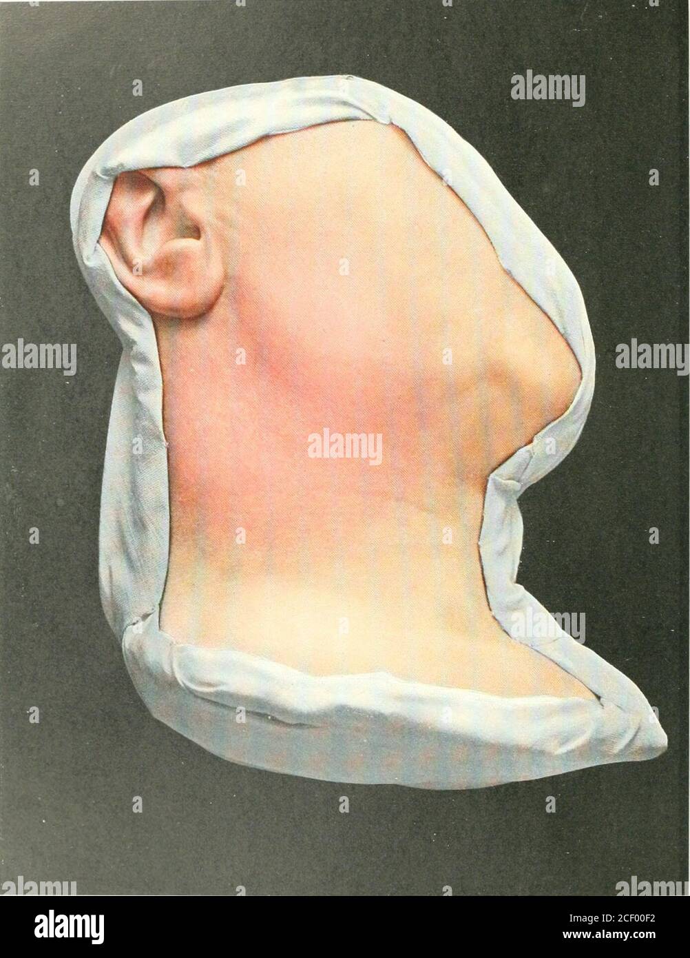 Phlegmonous High Resolution Stock Photography and Images - Alamy