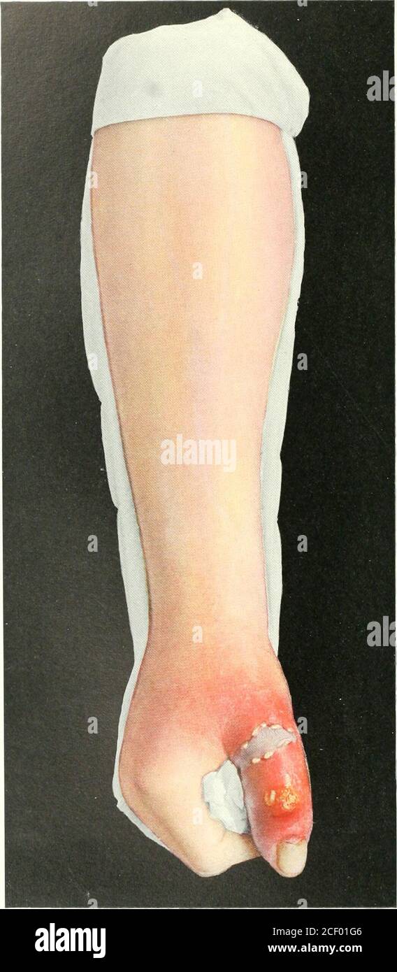 Panaritium hi-res stock photography and images - Alamy