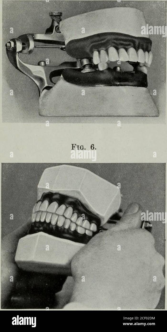 . The Dental cosmos. If the casts are not mounted in ananatomically ...