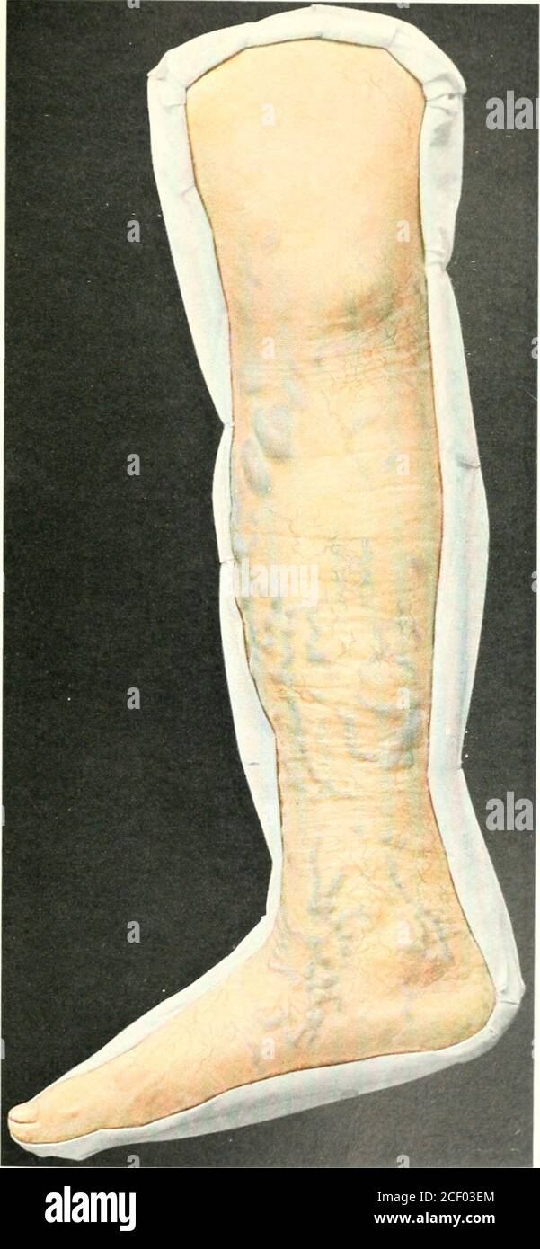 Small saphenous vein hi-res stock photography and images - Alamy