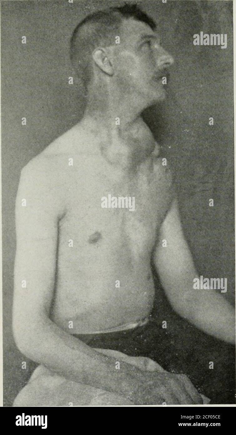 Clavicle excision hi-res stock photography and images - Alamy