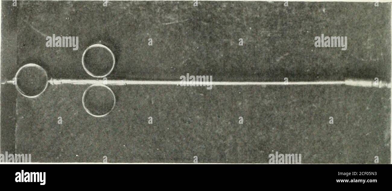 . Annals of surgery. X-ray photograph showing pencil top in left ...