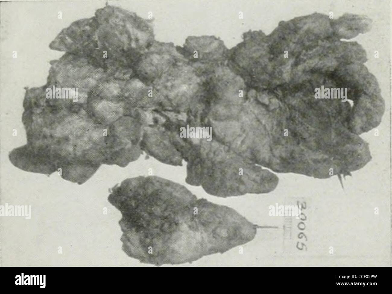 Stab incision hi-res stock photography and images - Alamy