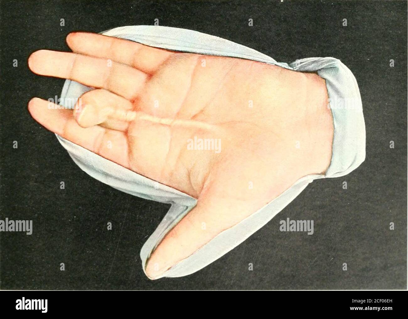 Contracture scars hi-res stock photography and images - Alamy