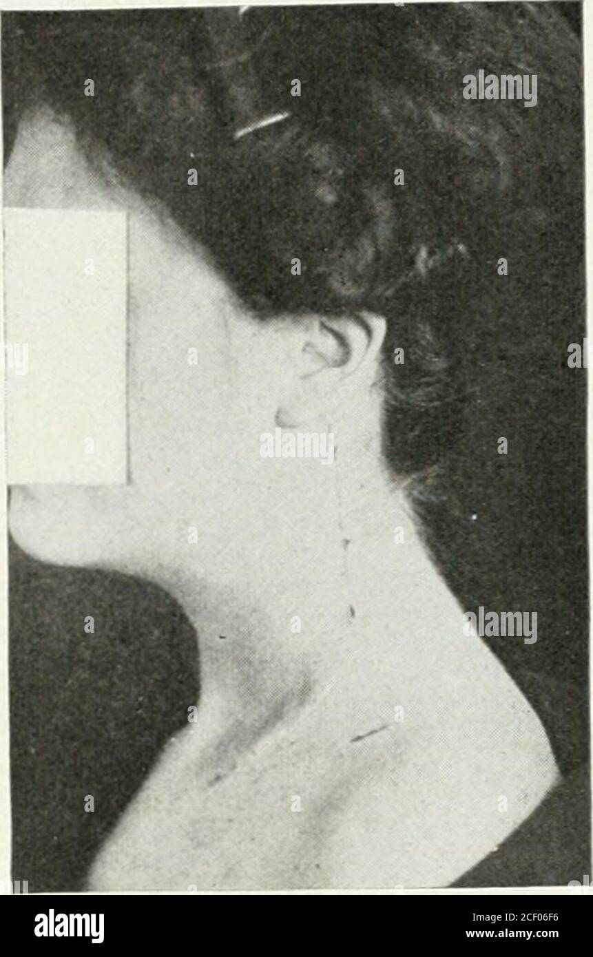 . Annals of surgery. Shows dissection completed. The spinal accessory ...
