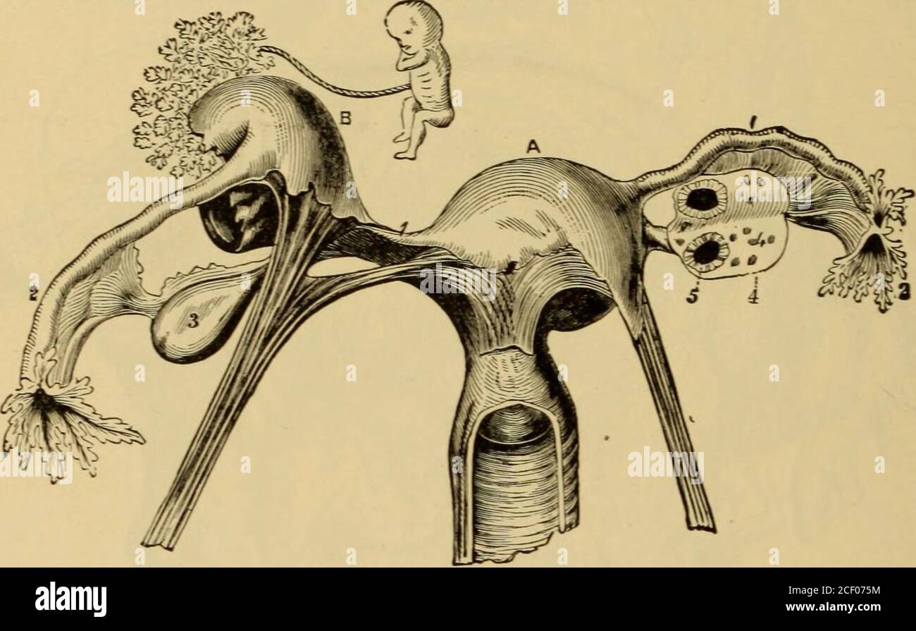Uterine rupture uterus hi-res stock photography and images - Alamy