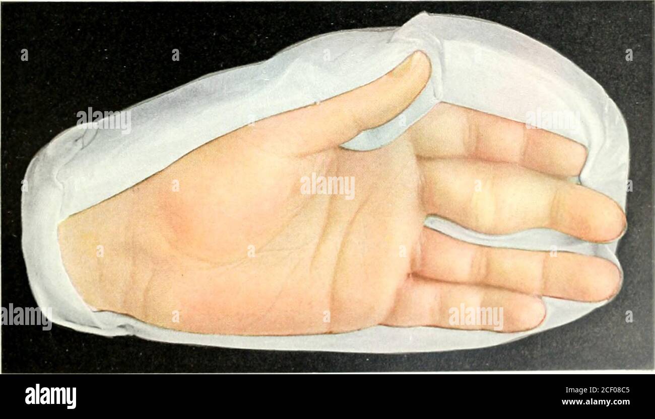 Fibrolipoma hi-res stock photography and images - Alamy