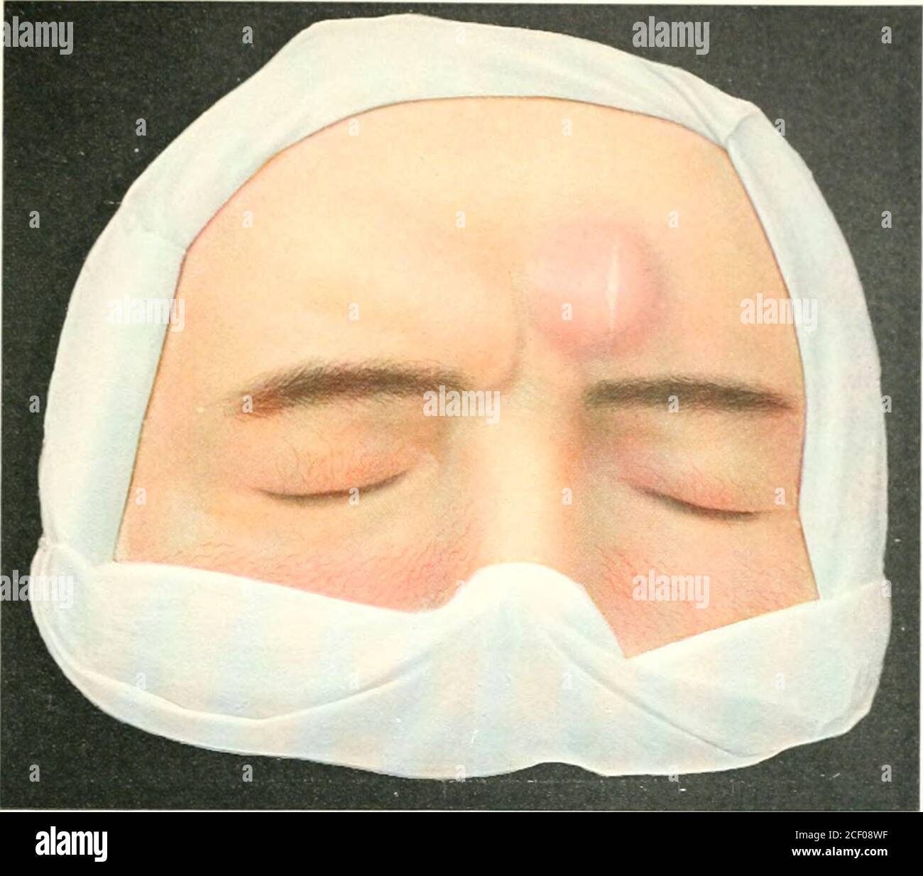 Occipital furrows hi-res stock photography and images - Alamy