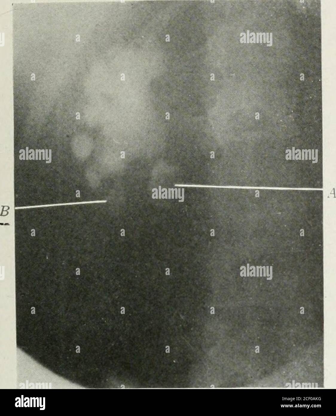 . Annals of surgery. A combination of mechanical and inflamma-tory ...