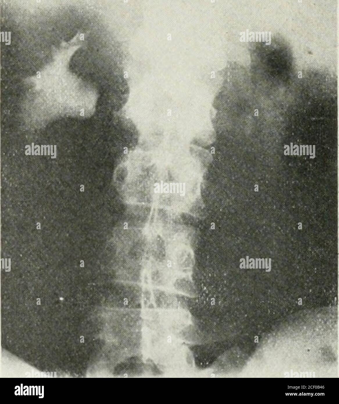 . Annals of surgery. Normal pelvis in actual colic afterinjecting 3 c.c ...