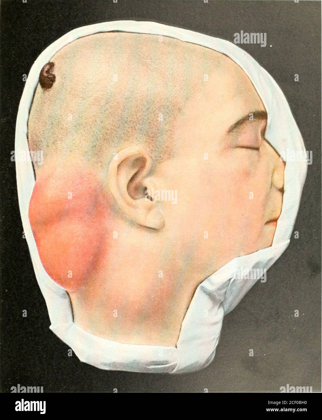 Tumor on the scalp hi-res stock photography and images - Alamy