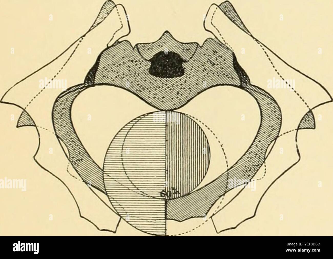 Symphysiotomy hi-res stock photography and images - Alamy