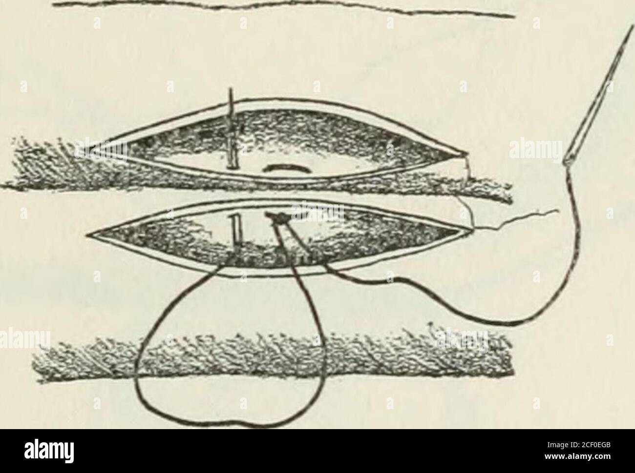 . Annals of surgery. STOMOSIS. Fig. 3 shows two loops of intestine ...