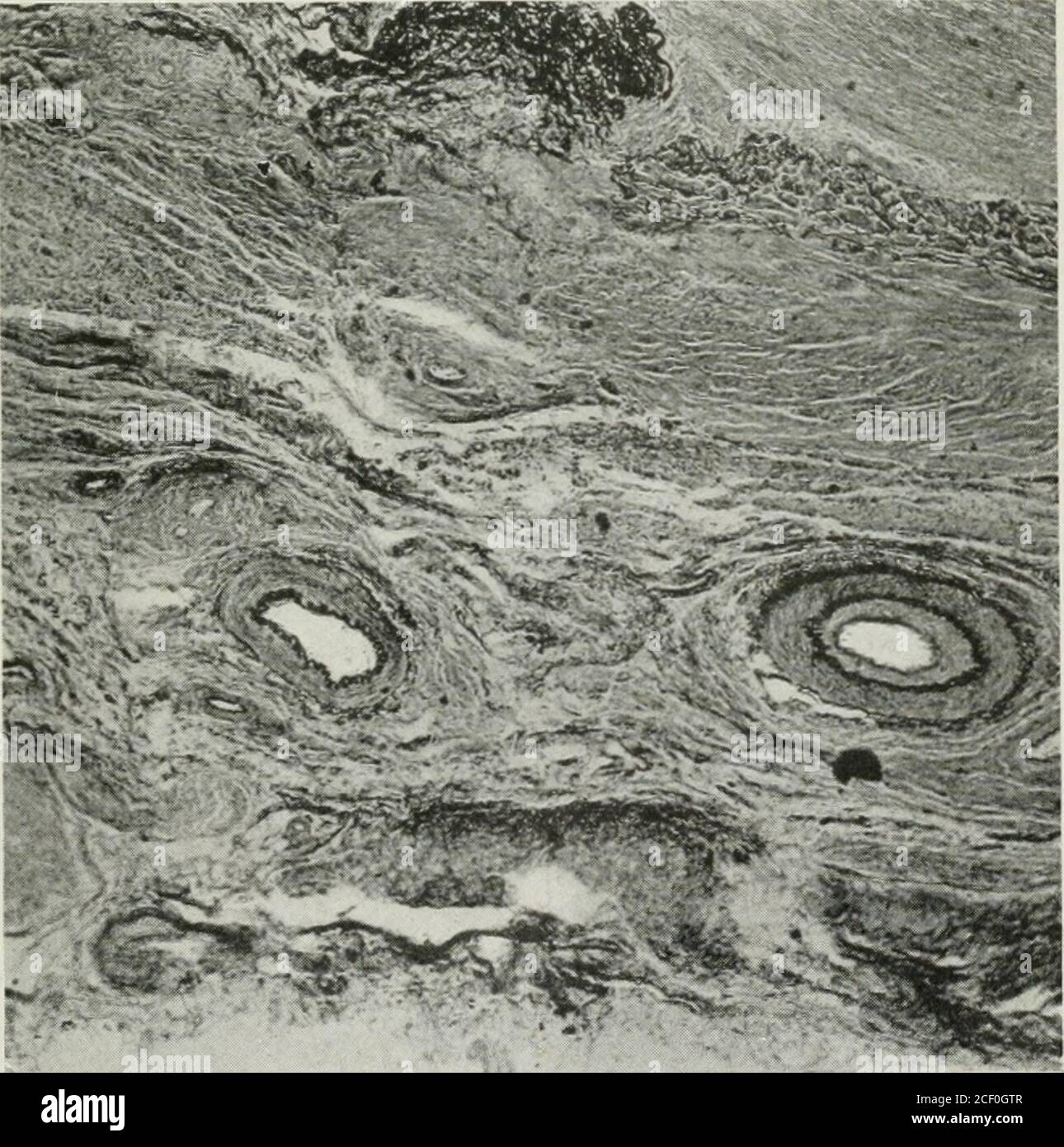 . Annals of surgery. Longitudinal section ol the upper arteriovenous ...