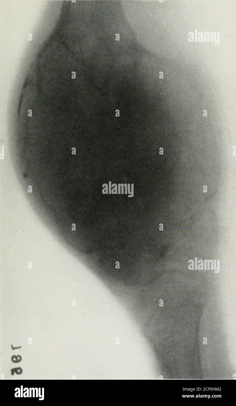 . Annals of surgery. Case HI. Small area showing perivascular giant ...