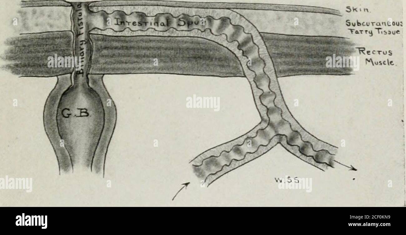 Anastomosis distal hi-res stock photography and images - Alamy