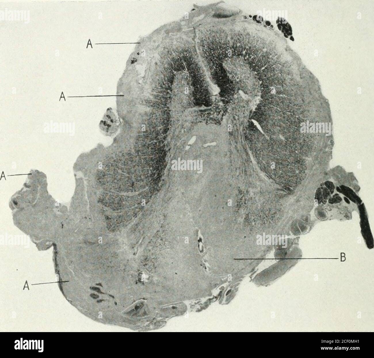 Spinal cord tumors hi-res stock photography and images - Alamy