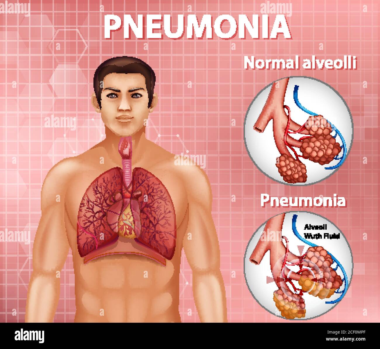 Alveoli comparison hi-res stock photography and images - Alamy