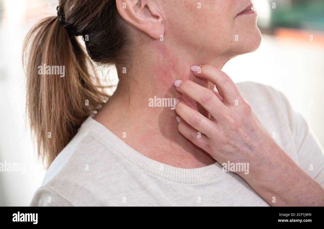 Woman having itchy and scratching her neck. Allergy symptoms Stock ...