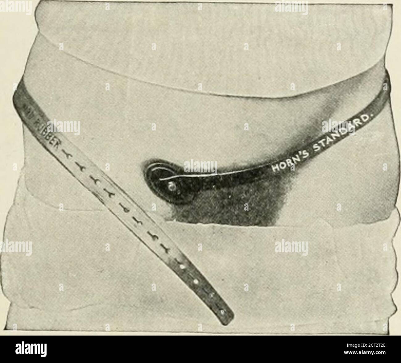 . Abdominal hernia : its diagnosis and treatment. 4. Hard-rubber cross ...