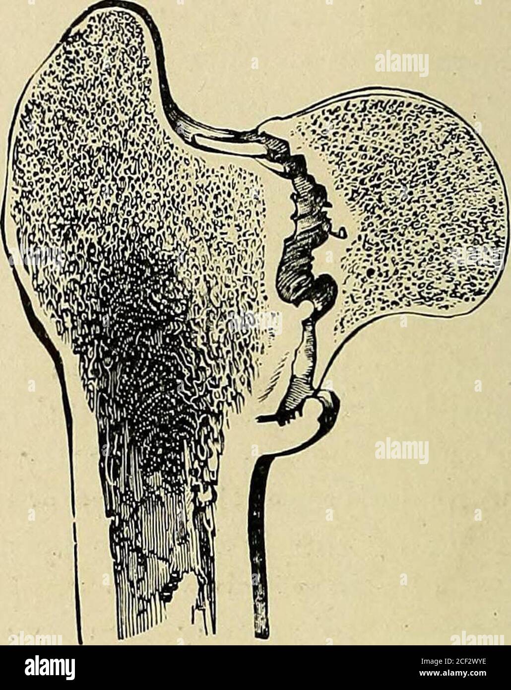 . A practical treatise on fractures and dislocations. Fracture within ...