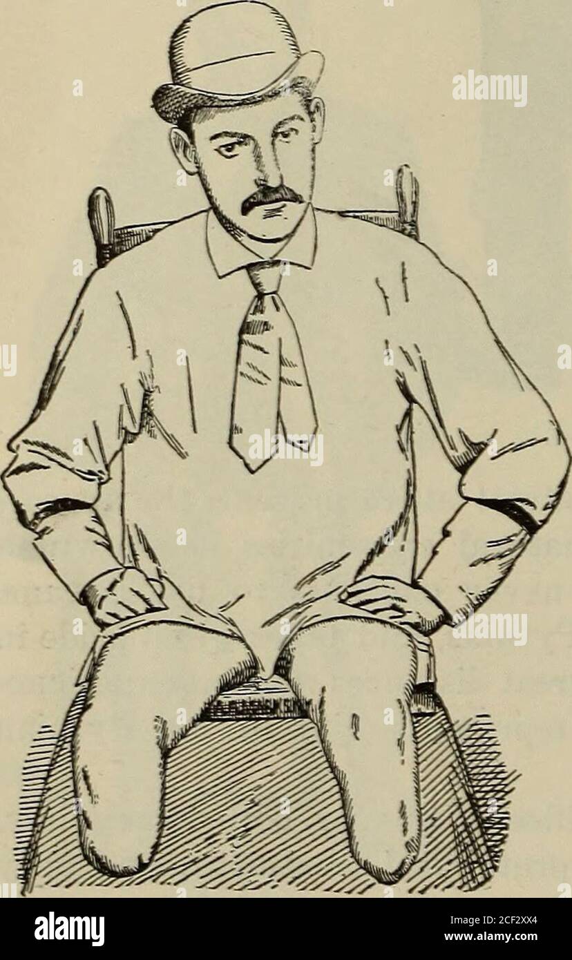 . A treatise on artificial limbs with rubber hands and feet ... No. 715 ...