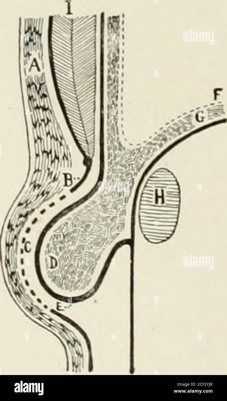 Extraperitoneal Fascia