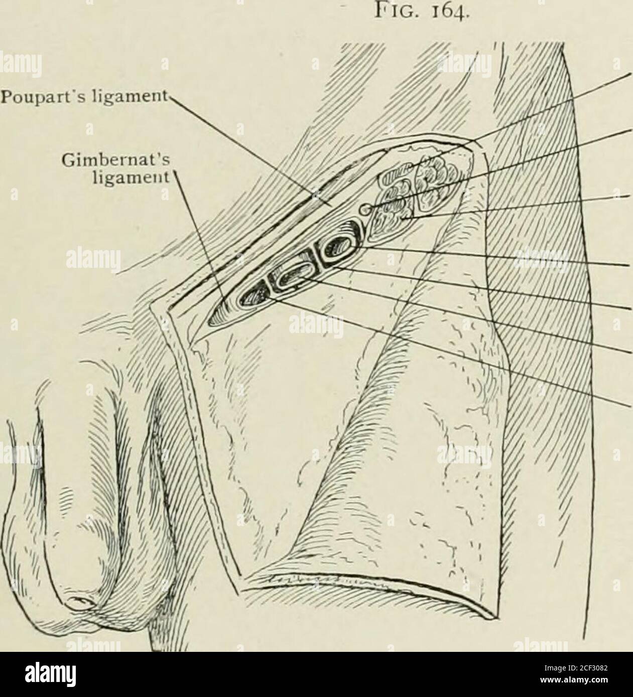 Hernia De Fascia Transversal Hesselbach Triangle: What Is It,