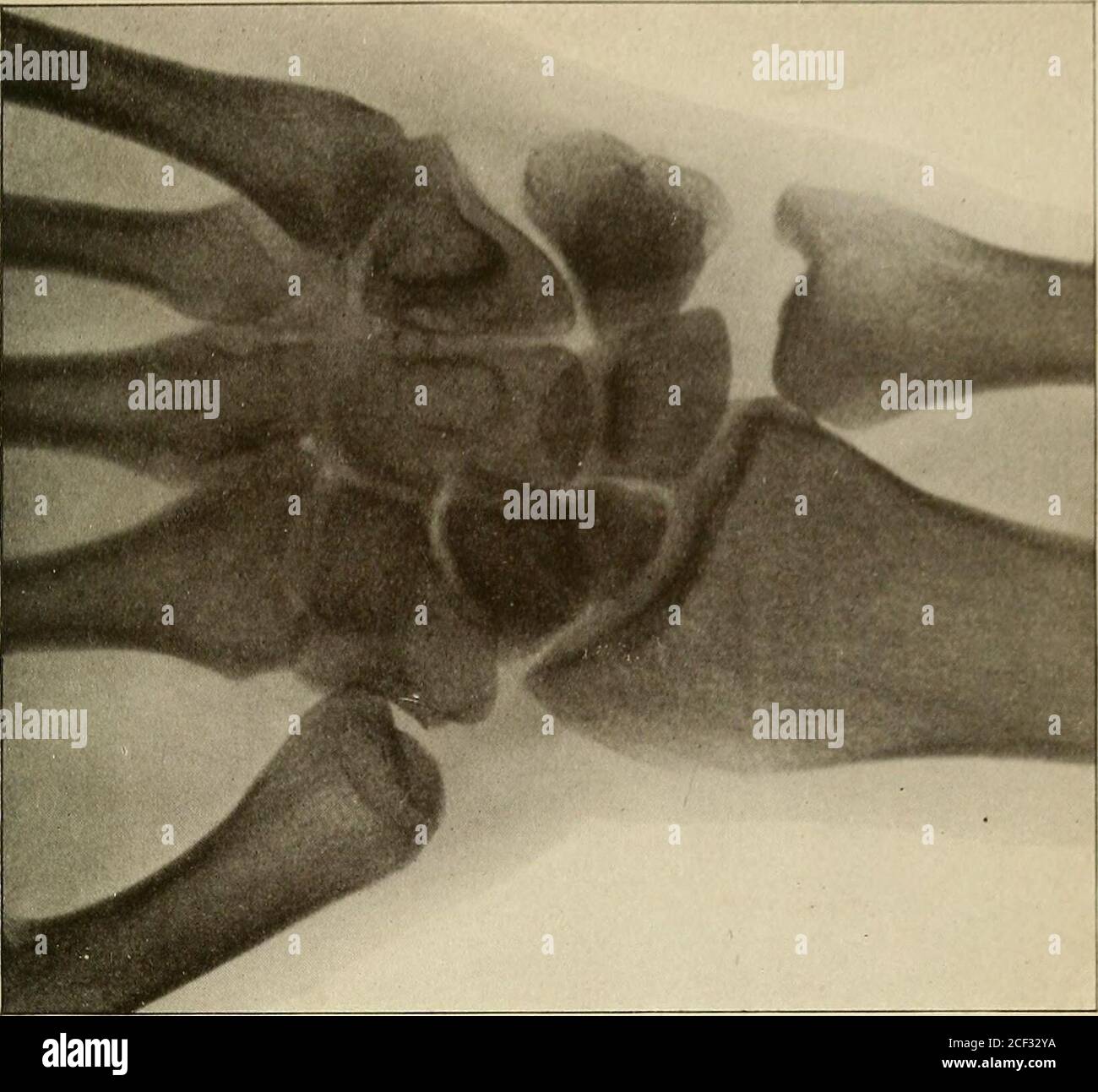 . A practical treatise on fractures and dislocations. After Removal of ...