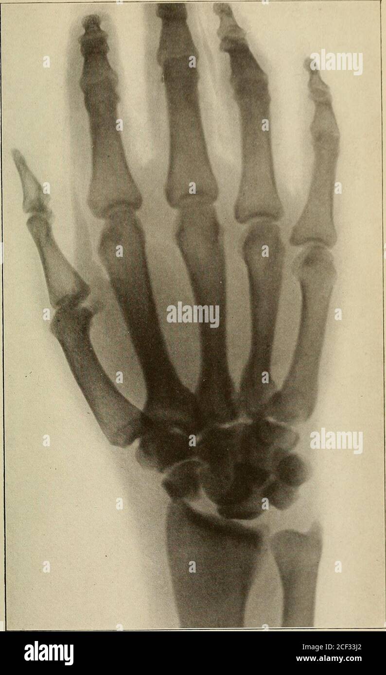. A practical treatise on fractures and dislocations. Fracture of ...