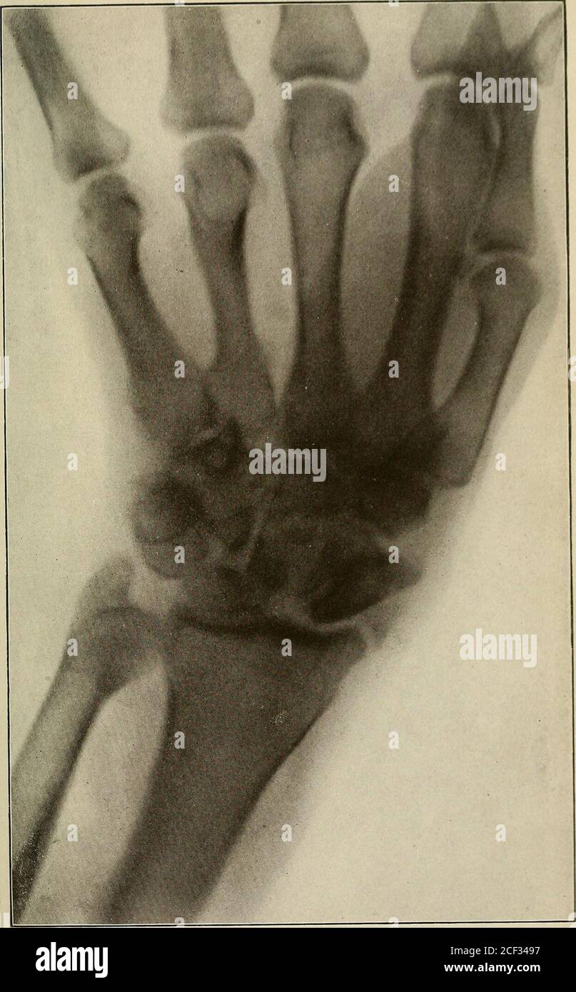 . A practical treatise on fractures and dislocations. Fracture of ...