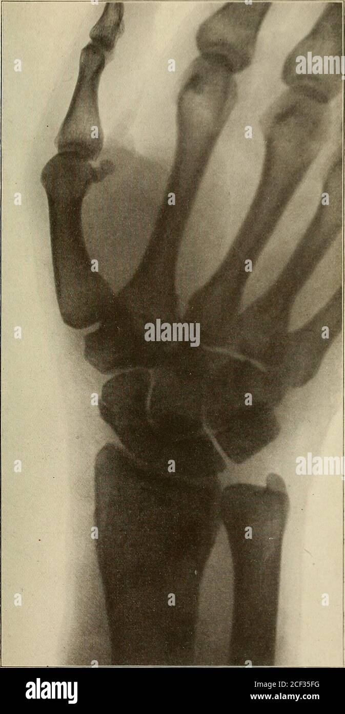 . A practical treatise on fractures and dislocations. Fracture of the ...