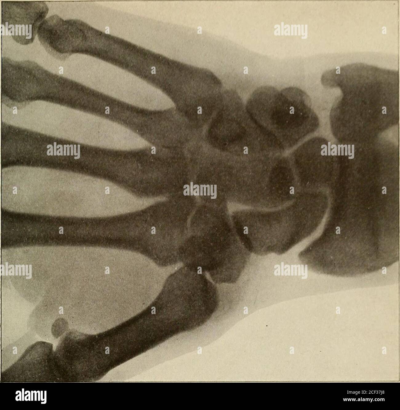 . A practical treatise on fractures and dislocations. Fig 2.—Separation ...