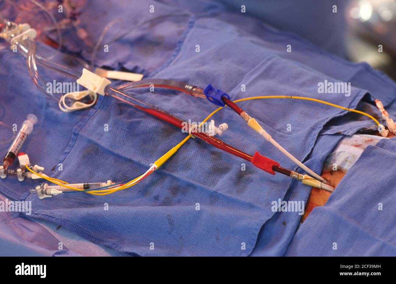 MARYLAND, USA, 1995 - Coronary intervention procedure. Heart lung ...