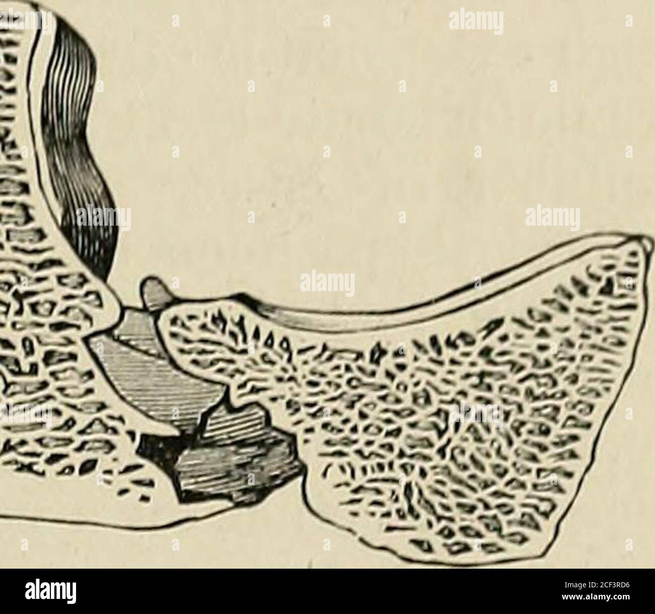 . A practical treatise on fractures and dislocations. Fracture of the ...