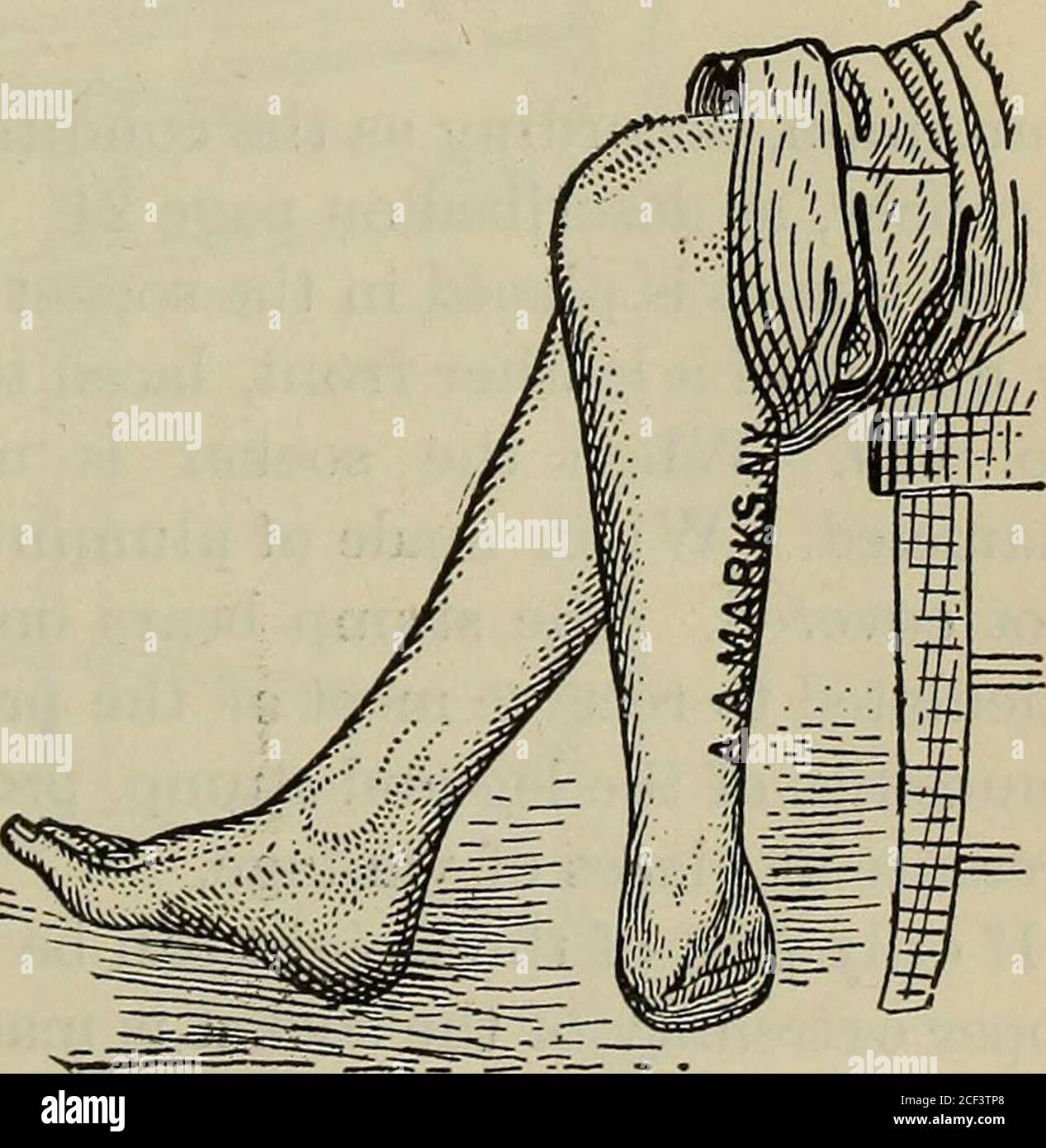 Symes amputation hi-res stock photography and images - Alamy