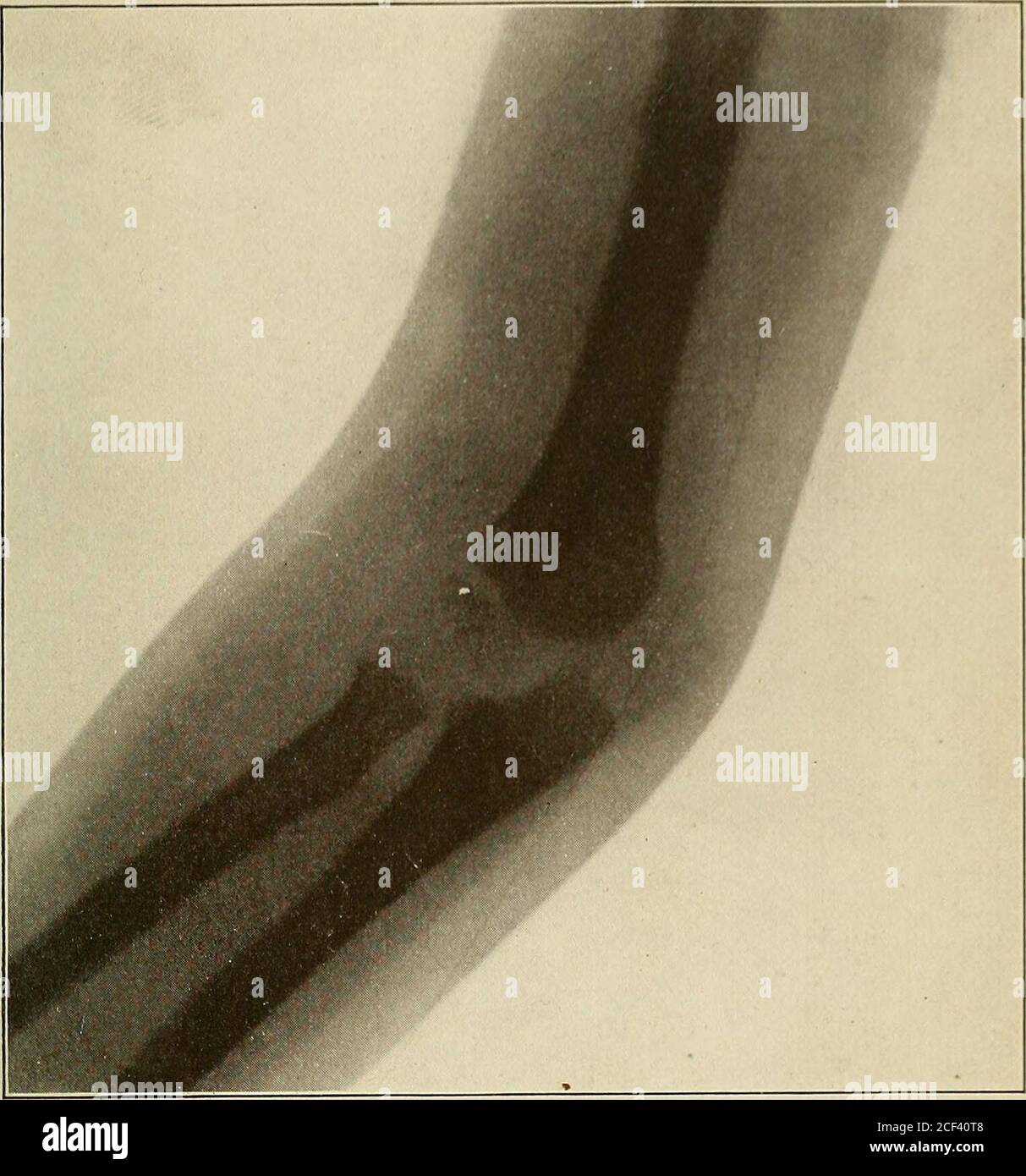 . A practical treatise on fractures and dislocations. Supracondyloid ...