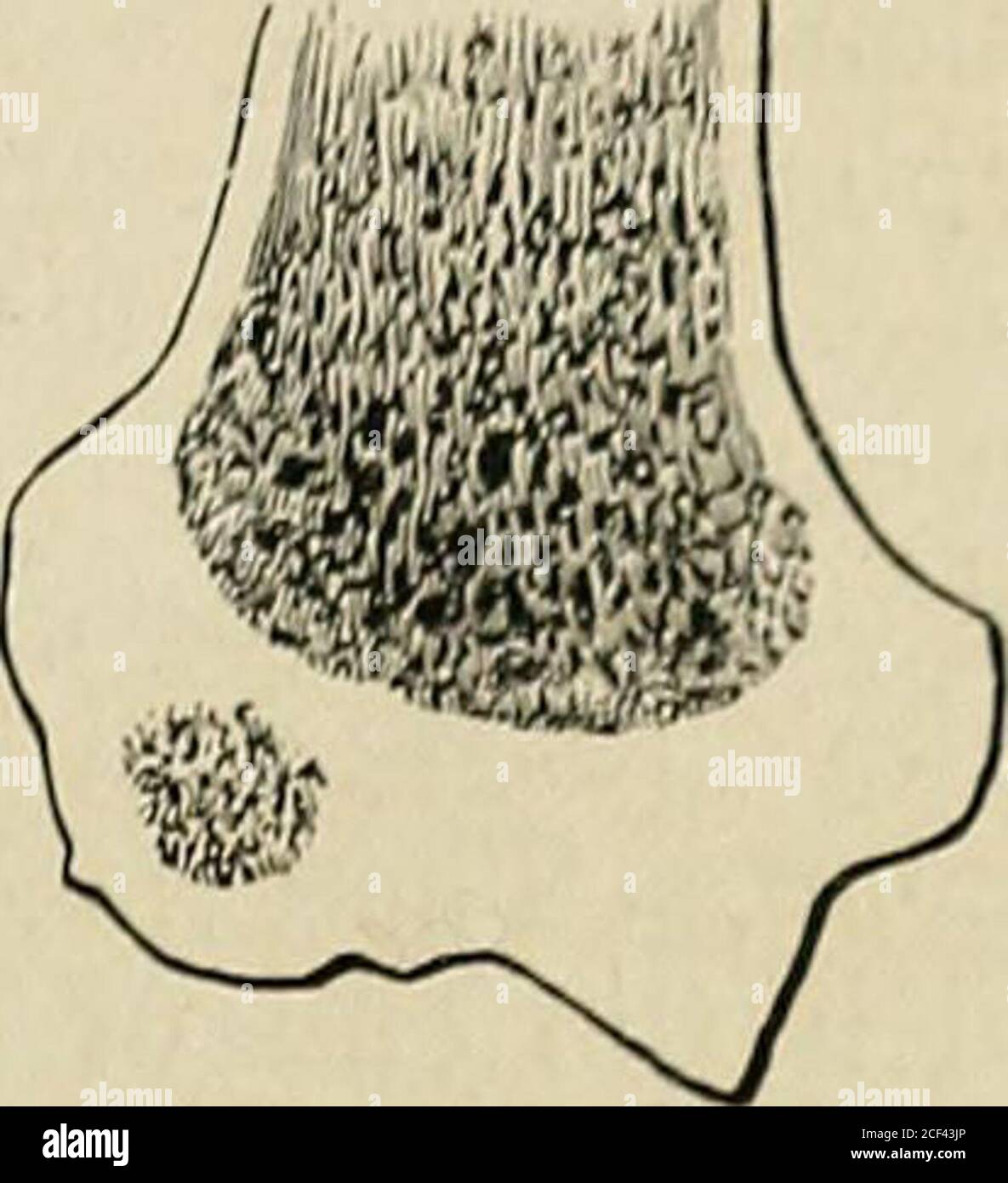 . A practical treatise on fractures and dislocations. Fig. 126. Twelfth ...
