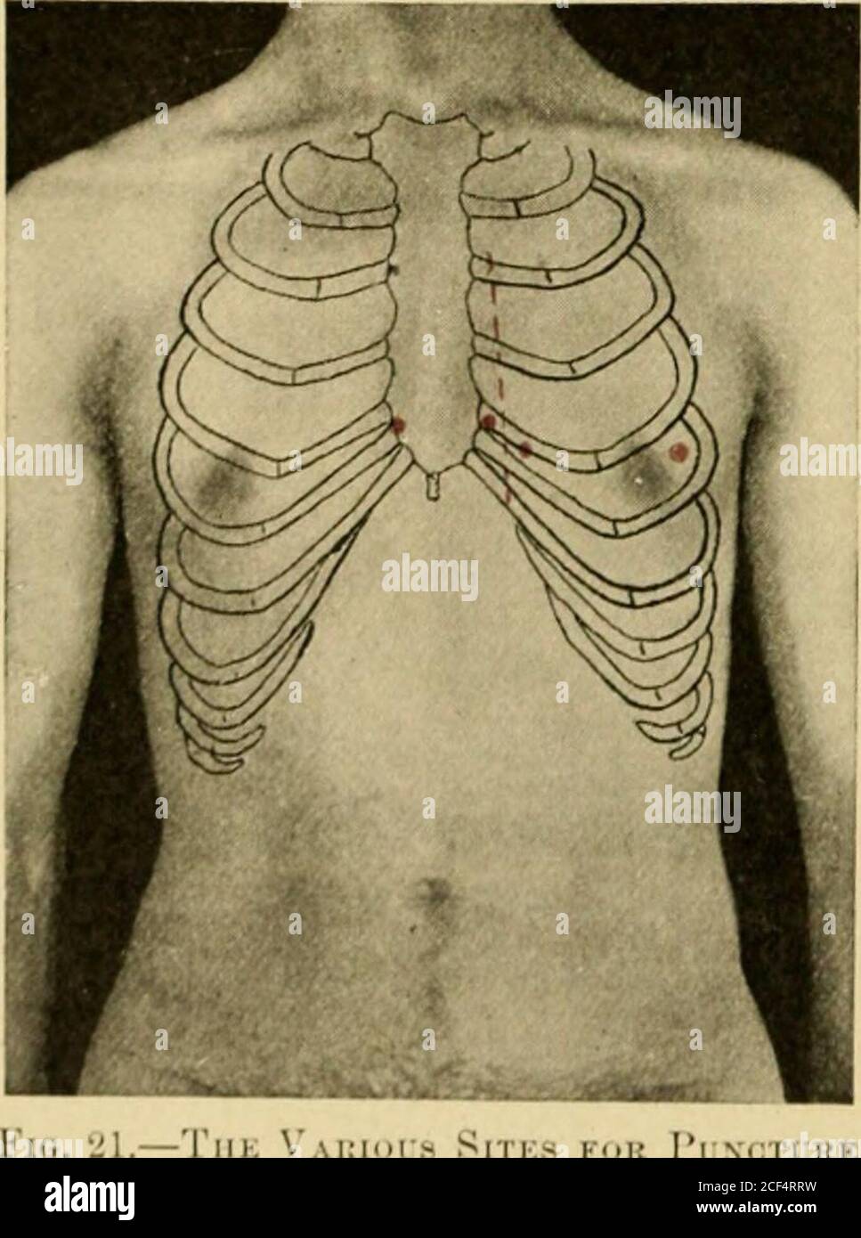Arterial puncture hi-res stock photography and images - Alamy