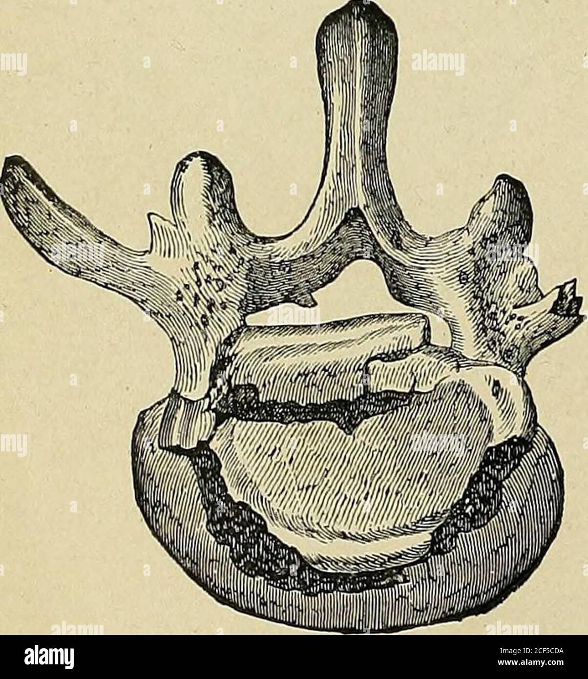 . A practical treatise on fractures and dislocations. Compression of ...