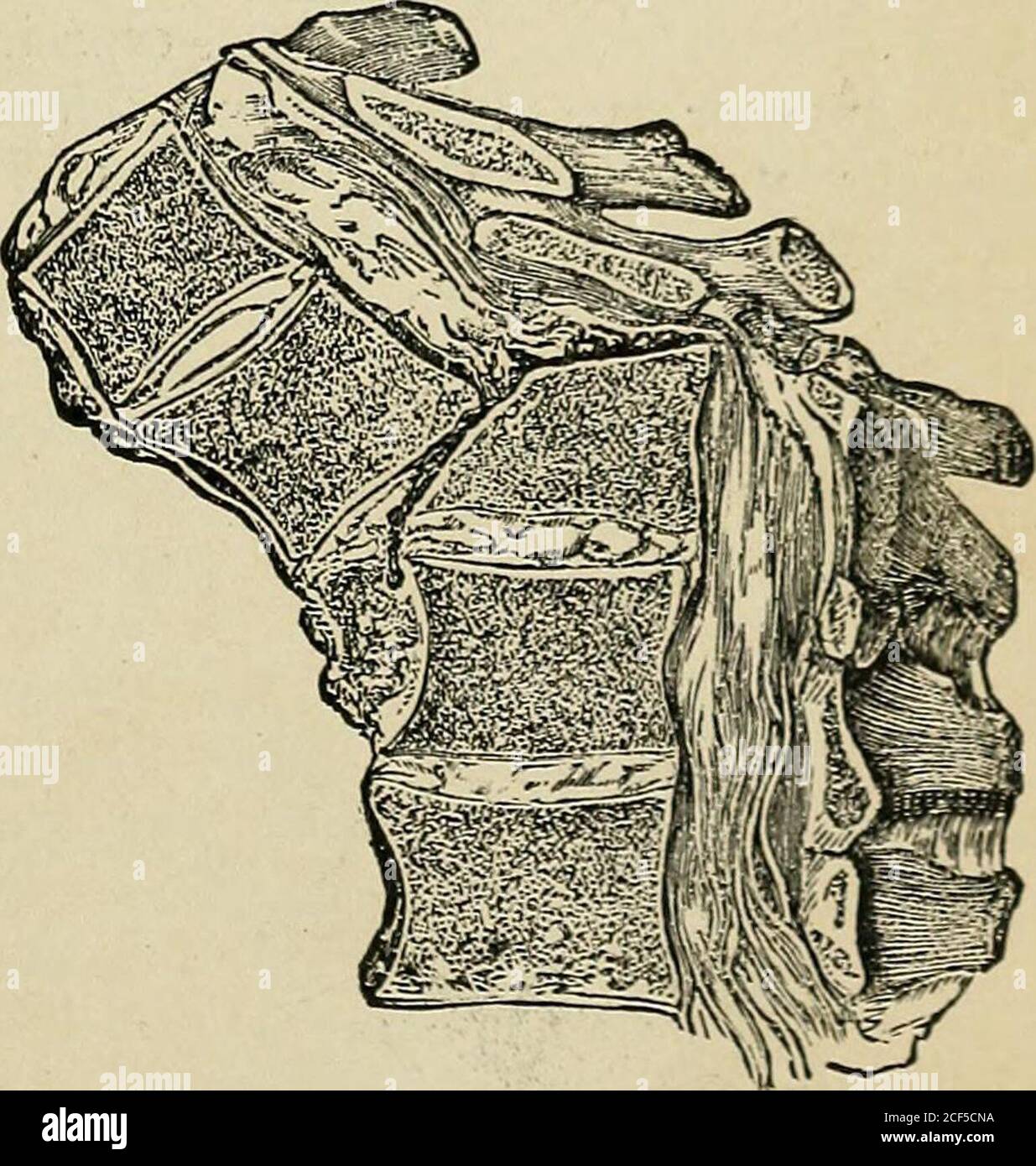 . A practical treatise on fractures and dislocations. Transverse ...