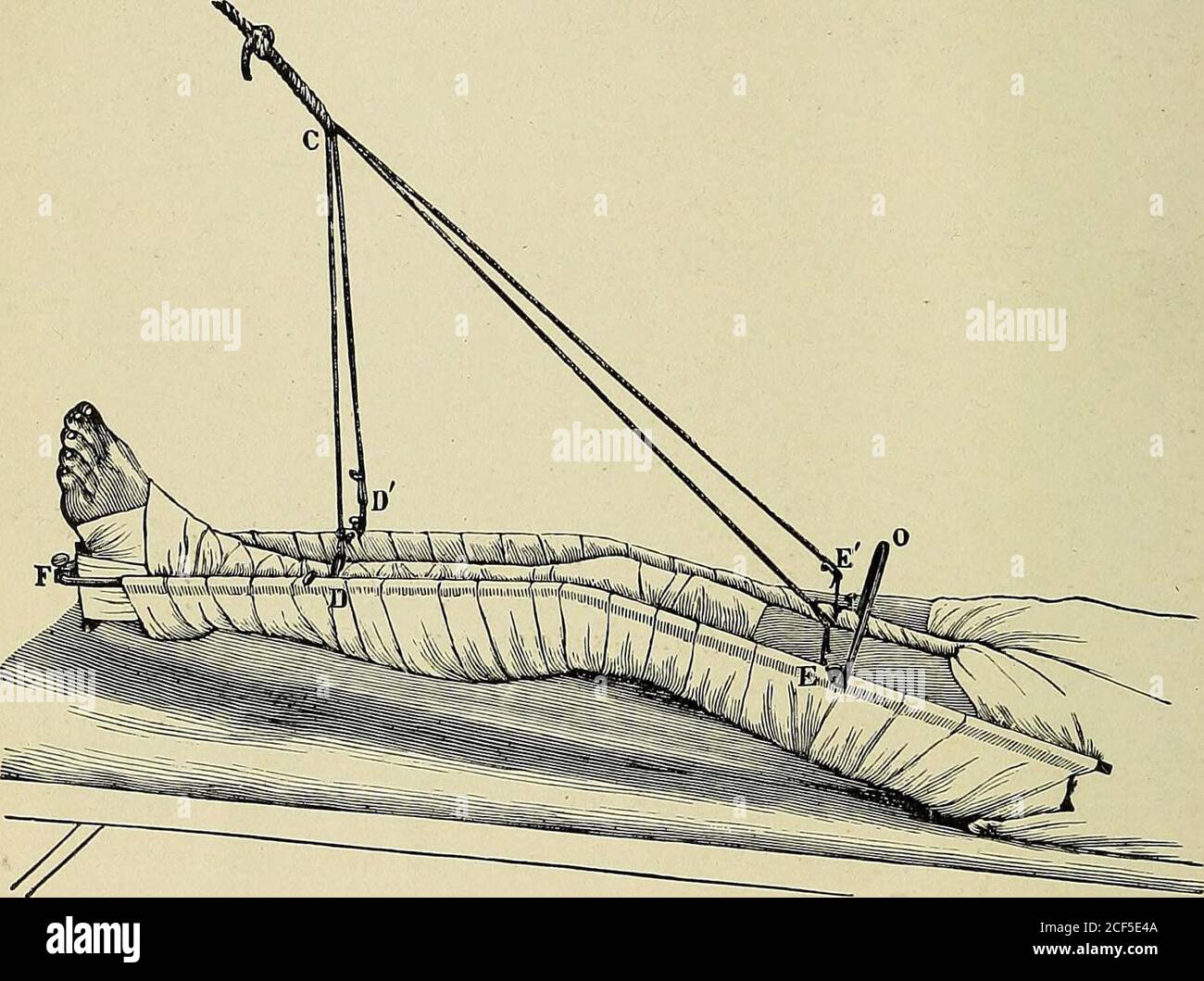. A practical treatise on fractures and dislocations. pieces of plaster ...