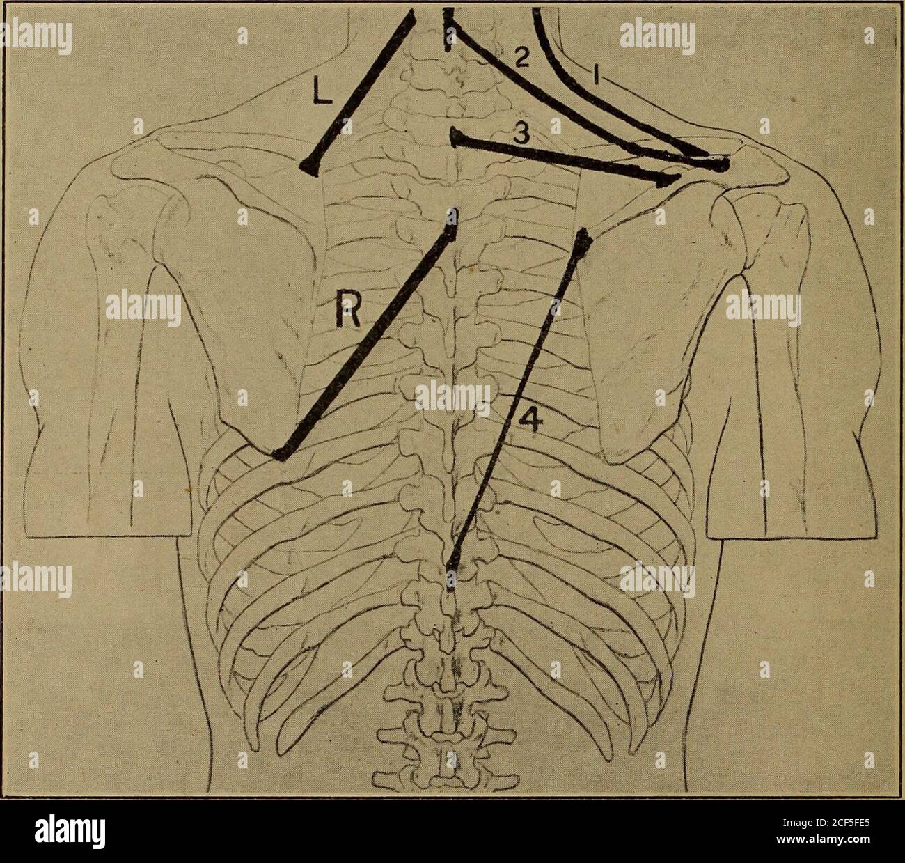 . Applied anatomy and kinesiology. Fig. 30.—Trapezius and latissimus ...