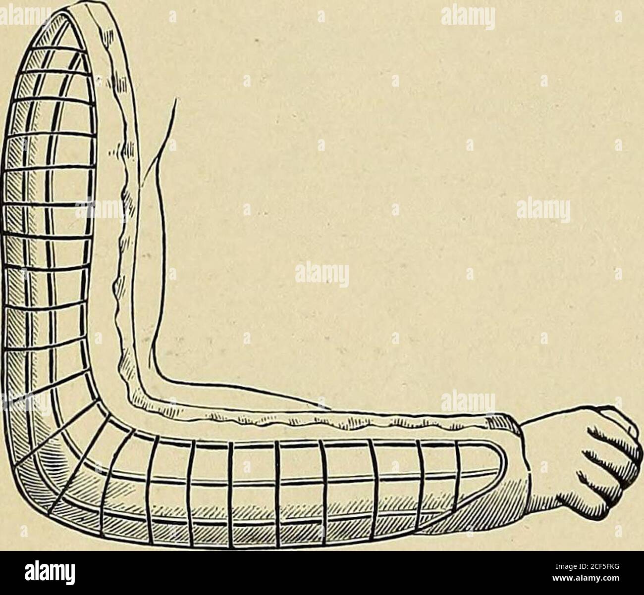 Rigid splints hi-res stock photography and images - Alamy